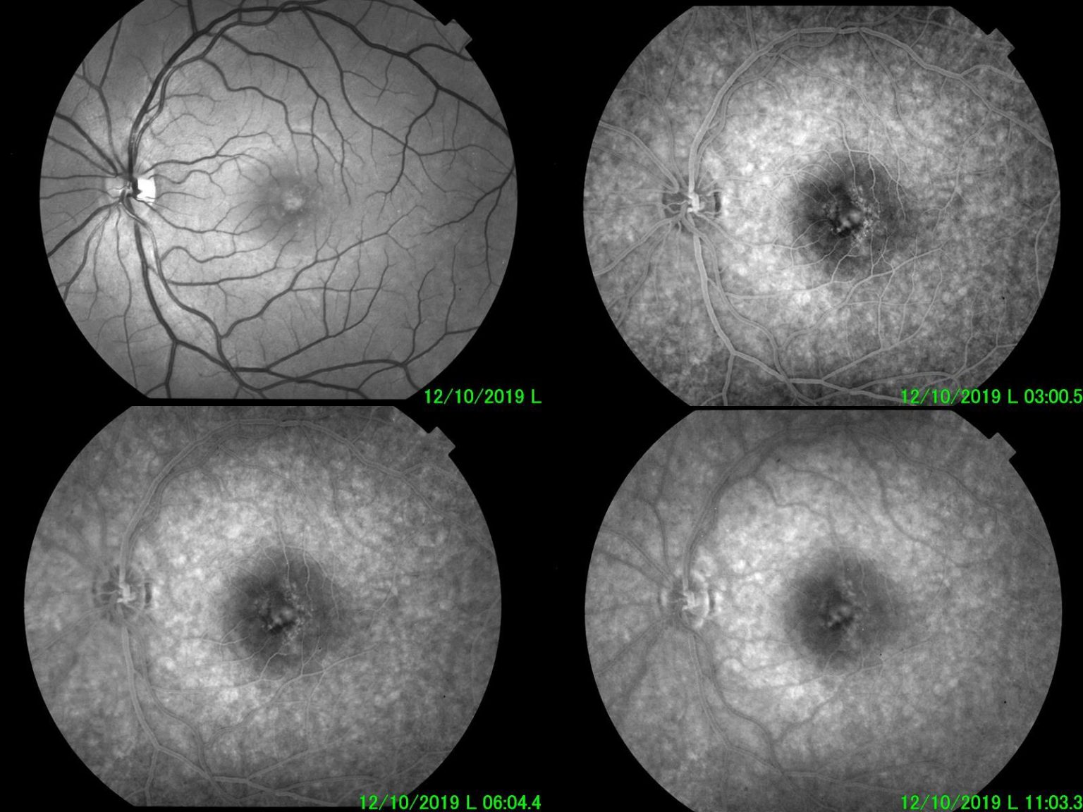 Retina | Suárez Oftalmología
