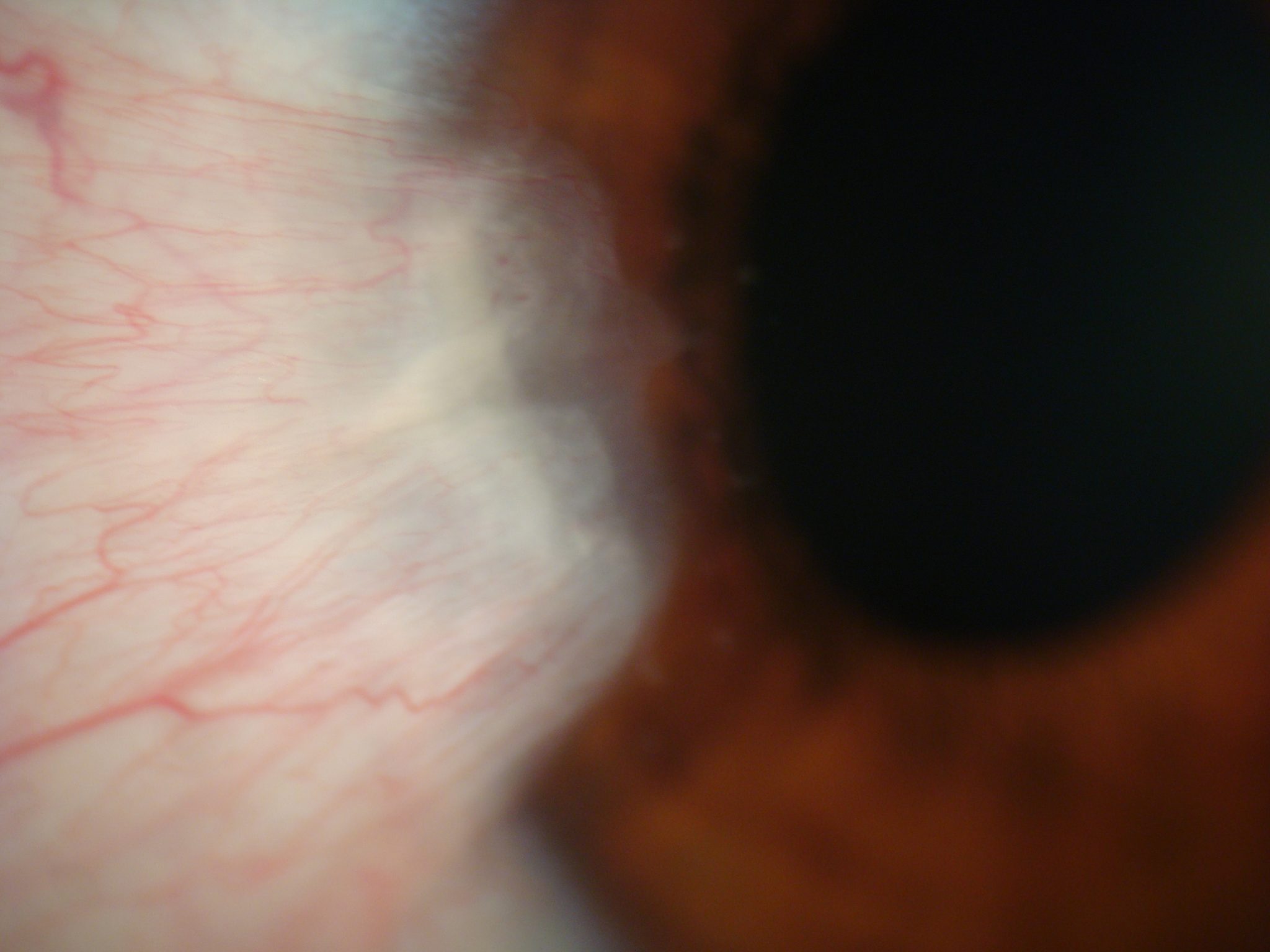 Pterigion | Suárez Oftalmología